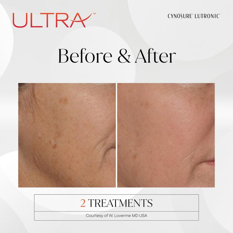 ULTRA Laser – Medical spa | London, ON | North London Skin ...